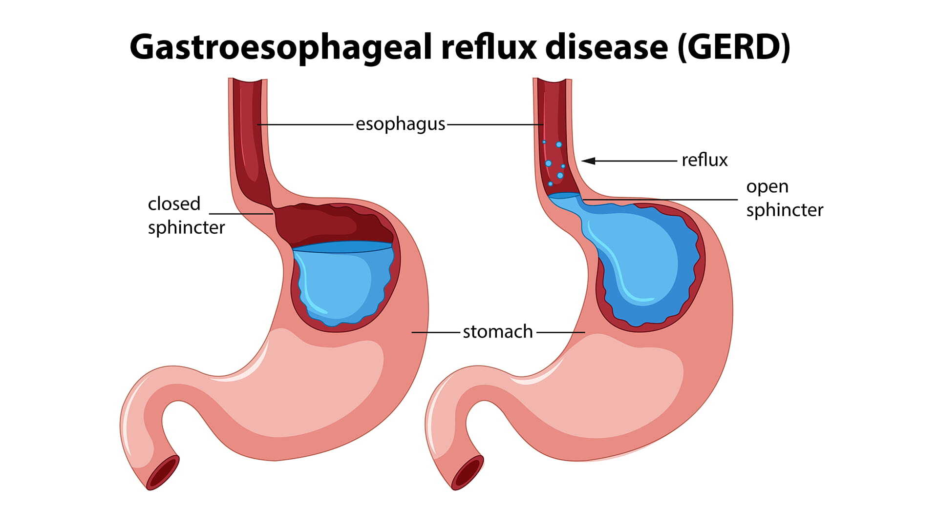 Understanding Gastroesophageal Reflux Disease: Here Is What You Need To ...