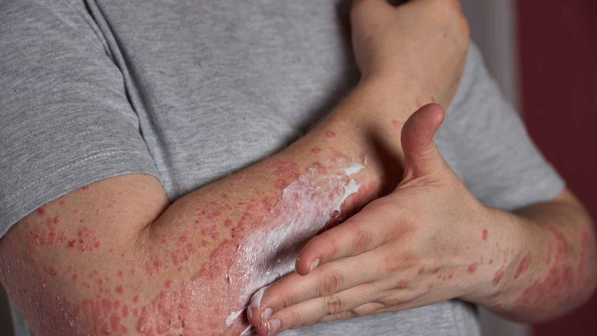 The ABCs of Toxic Epidermal Necrolysis: Causes, Signs, and Care - Gotonews